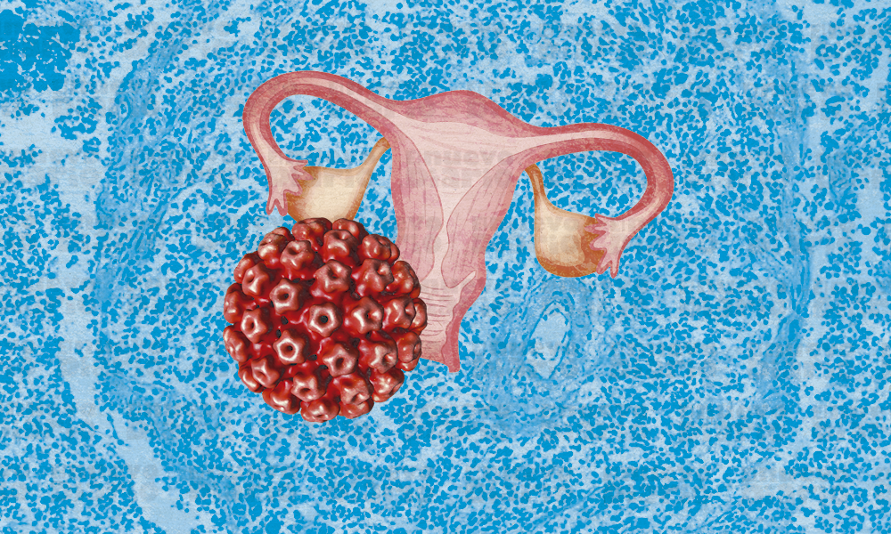 Diagnóstico temprano del virus VPH ayuda a evitar el cáncer cérvico uterino