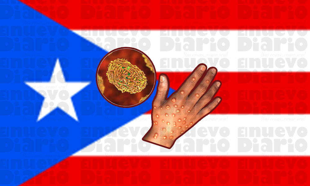 Puerto Rico se ubica en un segundo nivel de brote de viruela símica ...